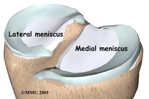 Menisküs Tedavisi - KizlarSoruyor