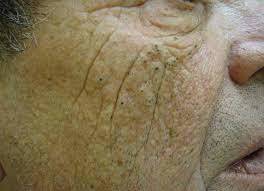 Cilt Hasarının En Büyük Sebebi! Foto Yaşlanma Hakkında Bilmeniz ...