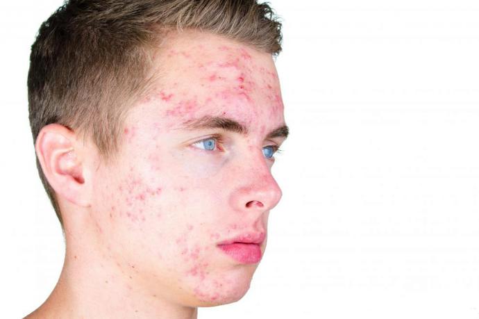 Sivilce Nasıl Geçer? Sivilceye Ne İyi Gelir?