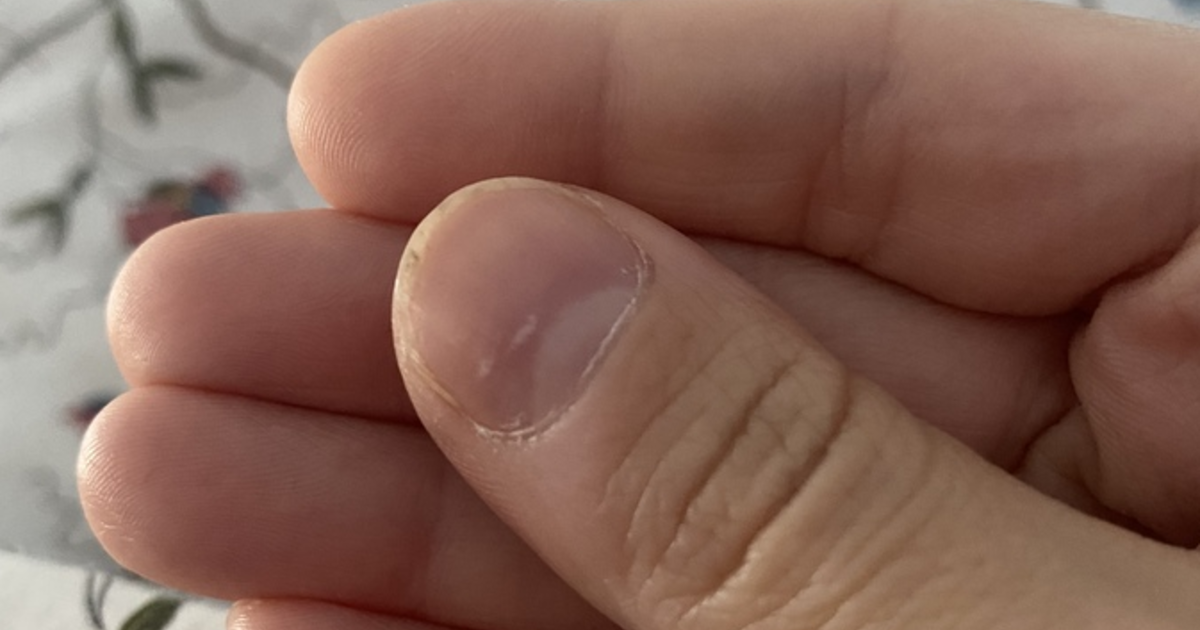 Tırnakta beyaz leke neden olur? - KizlarSoruyor