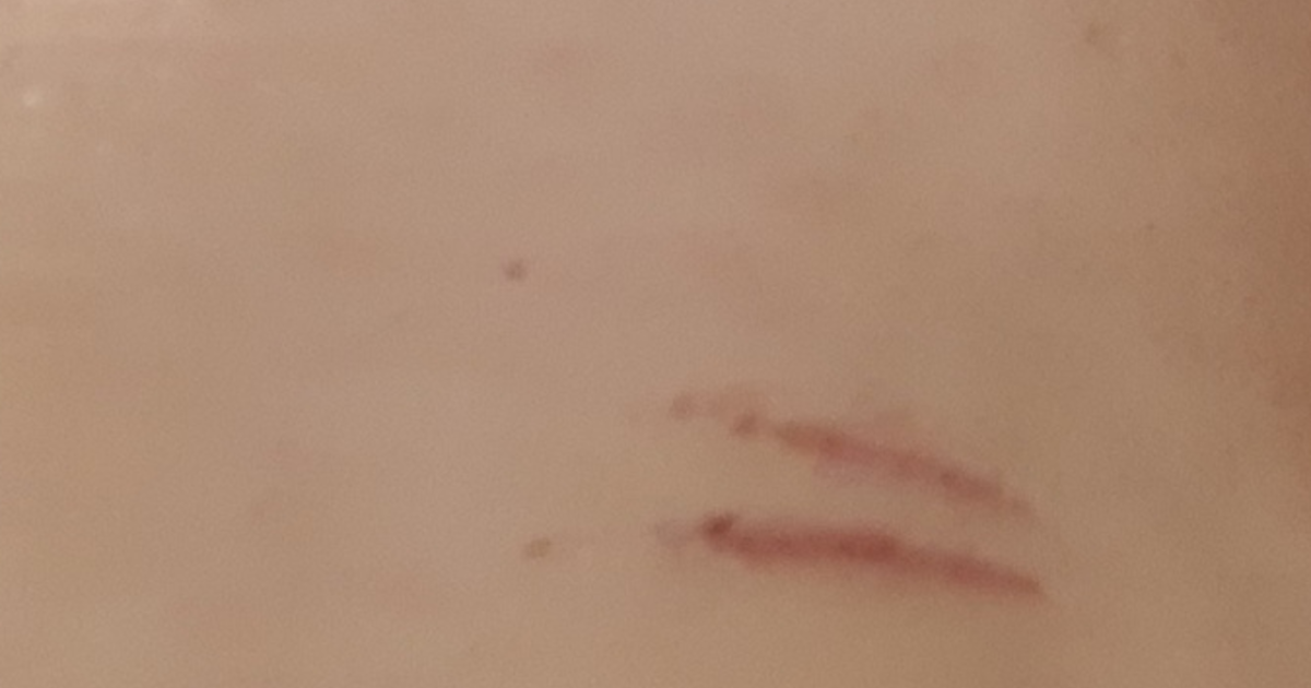 Lazere gittim vucudum yara içinde kaldı? Fotolu? Ağlamaktan mahvoldum ...