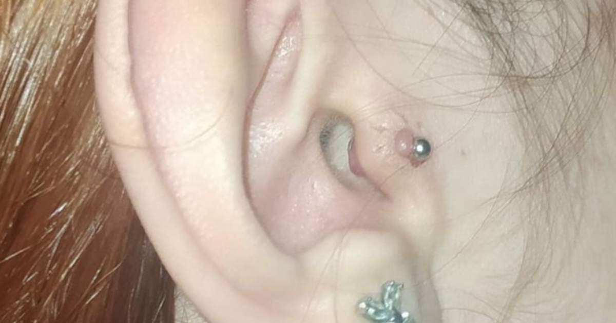 Tragusumda sanırım keloid çıktı? - KizlarSoruyor