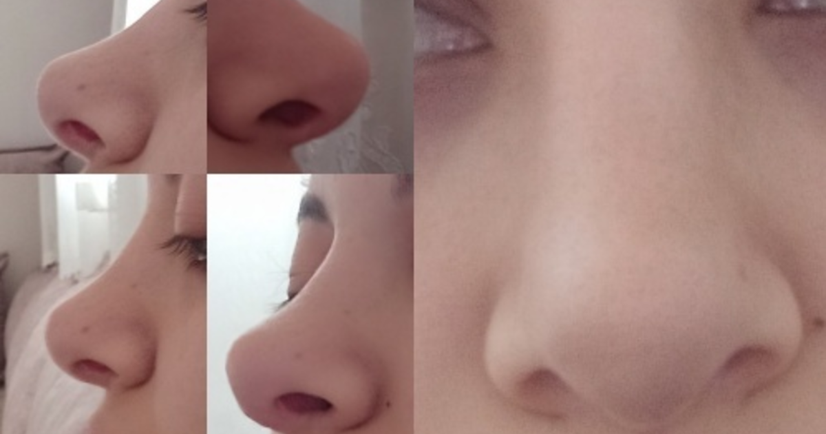 Burun estetiği oldum, burnumu beğenmiyorum. Ne yapacağım? - KizlarSoruyor