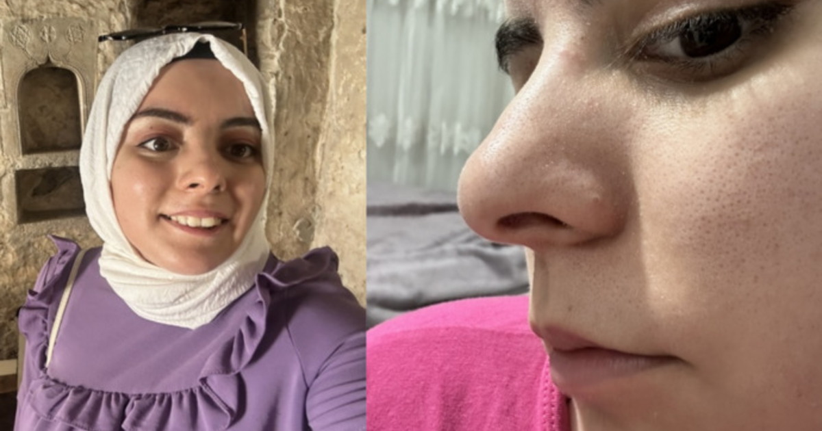 Burnum güzel mi, burun ameliyatı olmak istiyorum gerek var mı ...