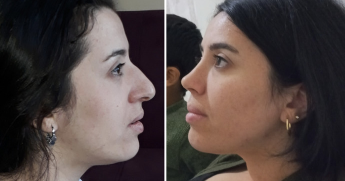 Burun ameliyatı oldum, öncesi ve sonrası böyle! Sizce nasıl olmuş? - KizlarSoruyor