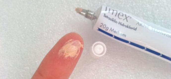 İmex Krem Sivilce İzlerini Lekelerini Geçirir mi, İyi Gelir mi?