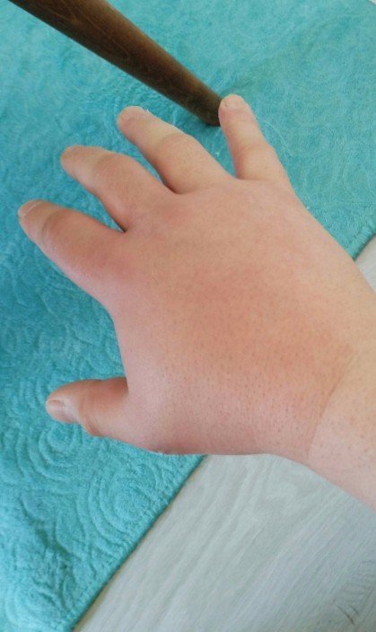 Ellerim hâlâ geçmedi , dermatolojiye gitsem düzelir mi? - KizlarSoruyor
