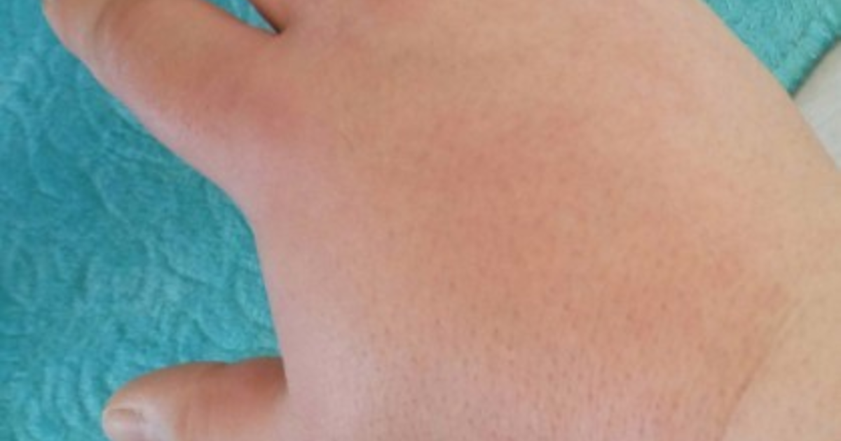 Ellerim hâlâ geçmedi , dermatolojiye gitsem düzelir mi? - KizlarSoruyor