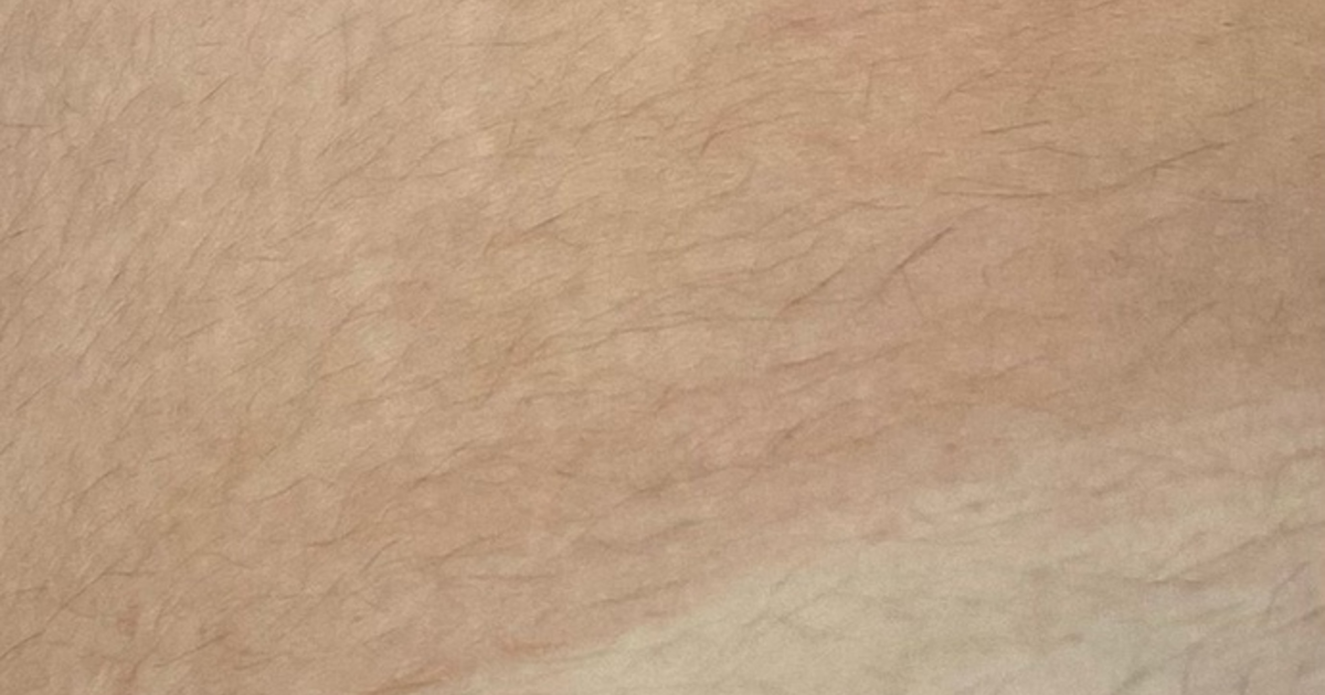 Havuz deniz vs sonrasi bu hale geldi ten rengim, bunu engellemenin bir ...