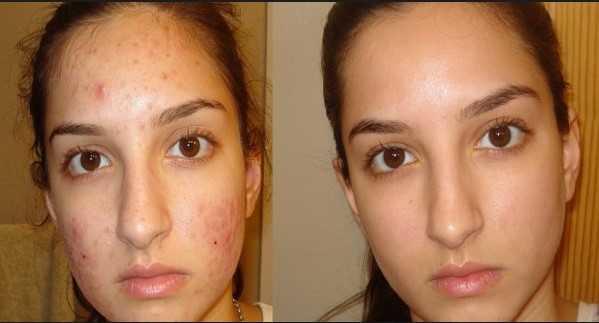 Sivex Losyon Kullananlar, Nasıl Kullanılır, Sivicelere İyi Gelir mi?